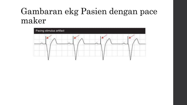 Temporary Pace Maker.pptx