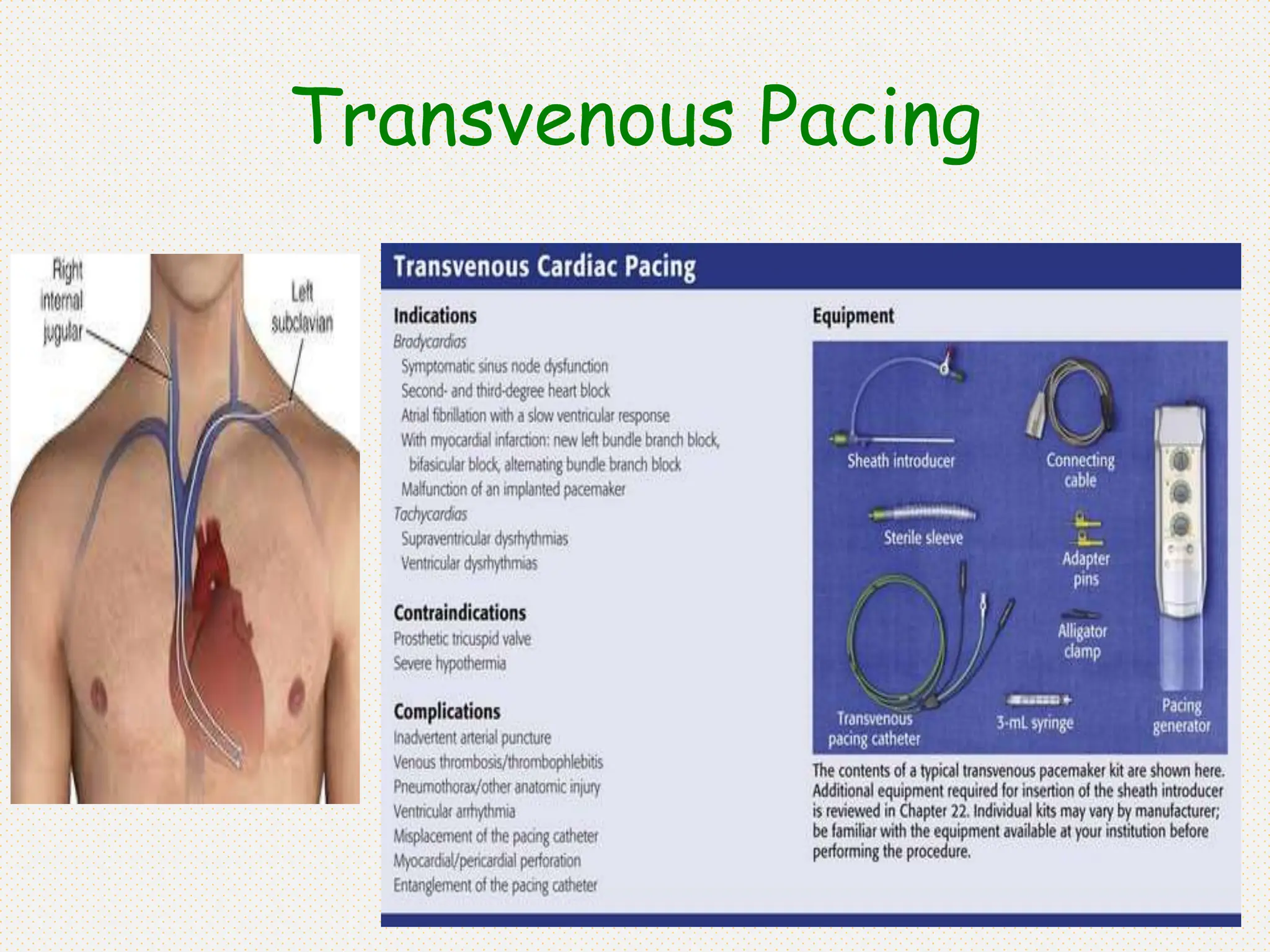 temporary pacemaker easy to learn for PICU | PPTX