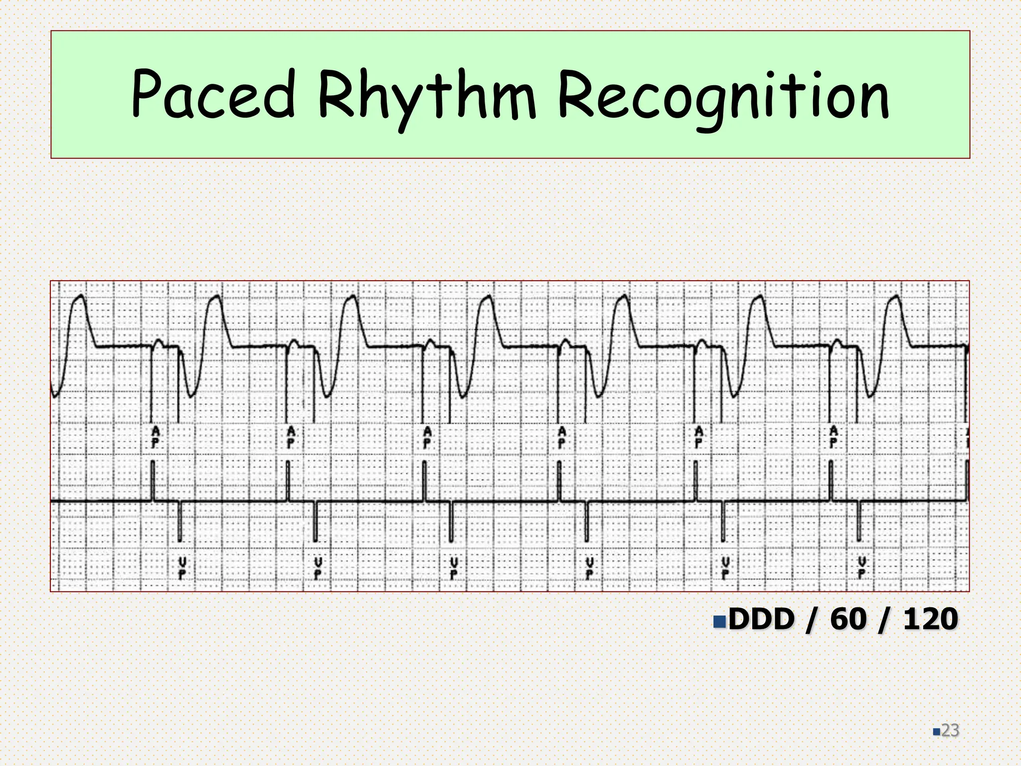 temporary pacemaker easy to learn for PICU | PPTX