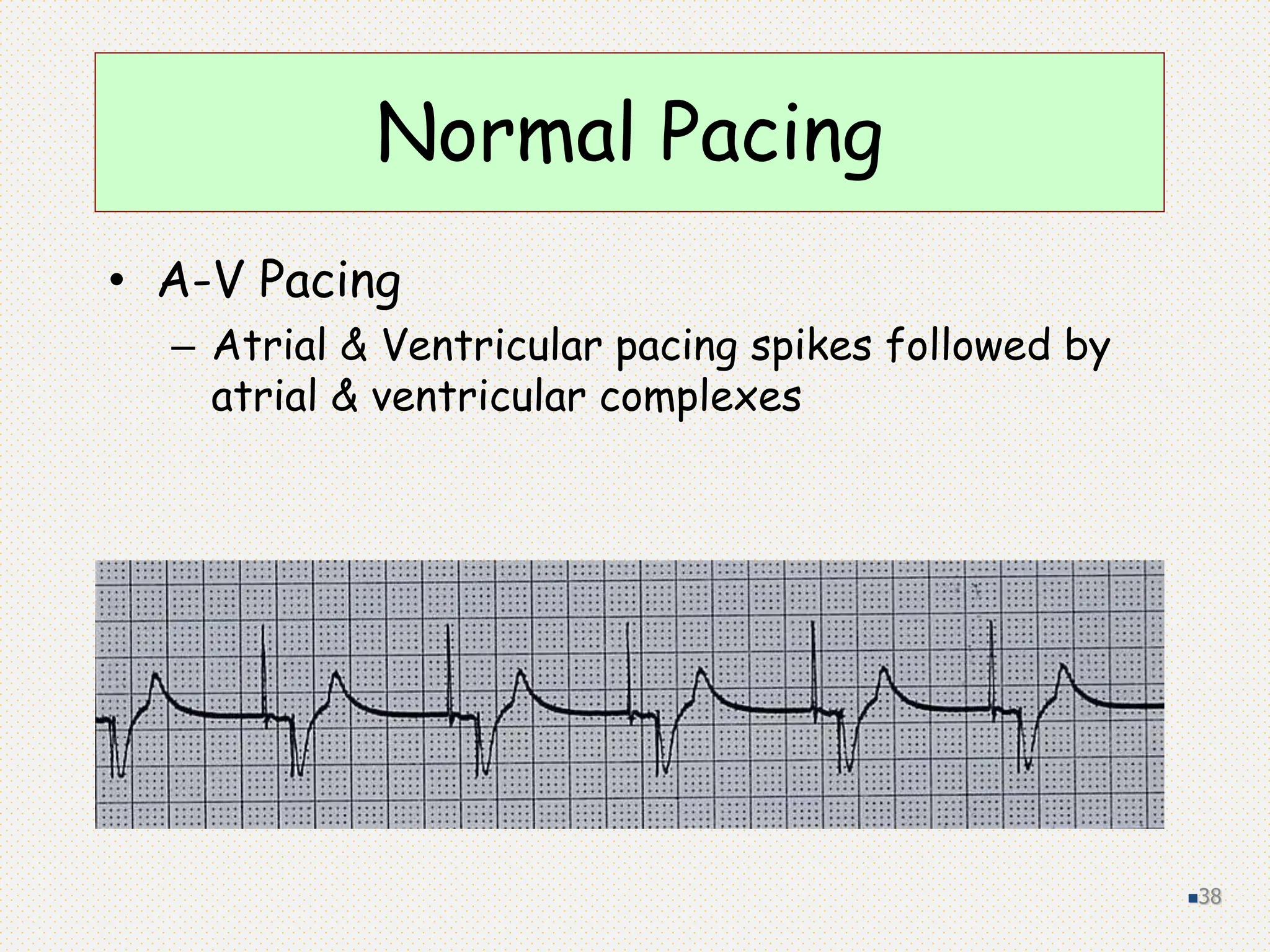 temporary pacemaker easy to learn for PICU | PPTX