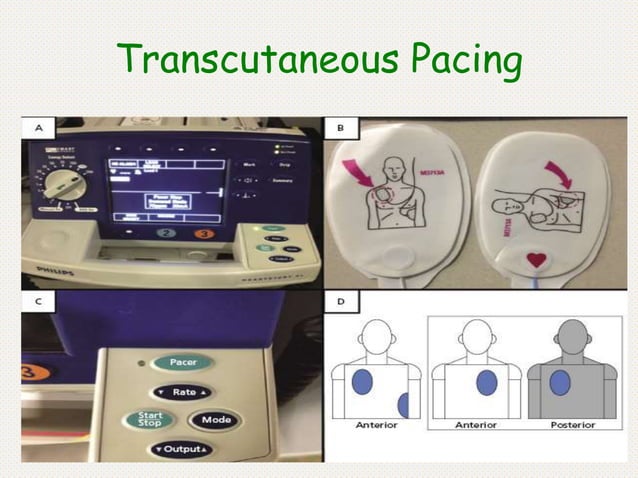 temporary pacemaker easy to learn for PICU | PPT