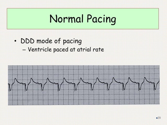 temporary pacemaker easy to learn for PICU | PPT