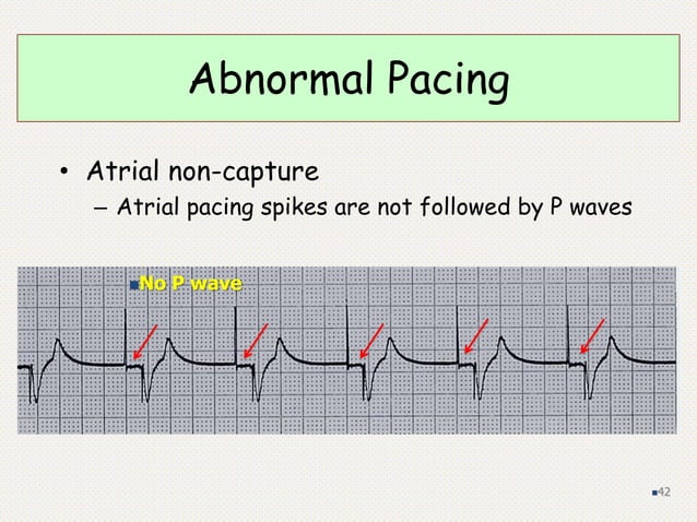 temporary pacemaker easy to learn for PICU | PPT