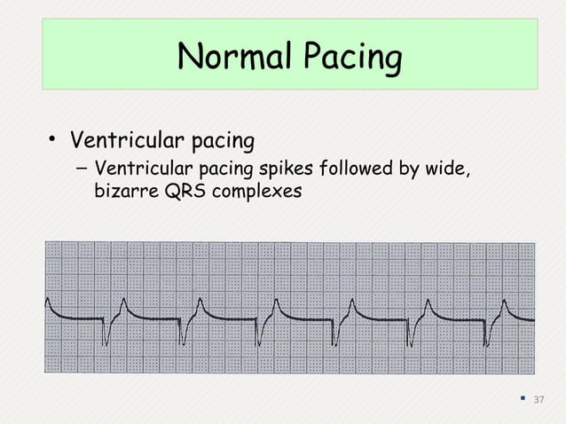 temporary pacemaker 2.pptx.............. | PPTX