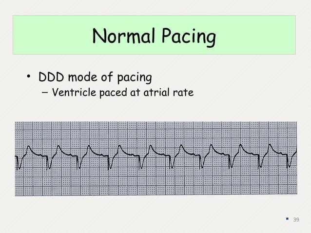 temporary pacemaker 2.pptx.............. | PPTX