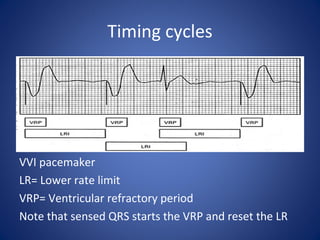 Pacemaker | PPT