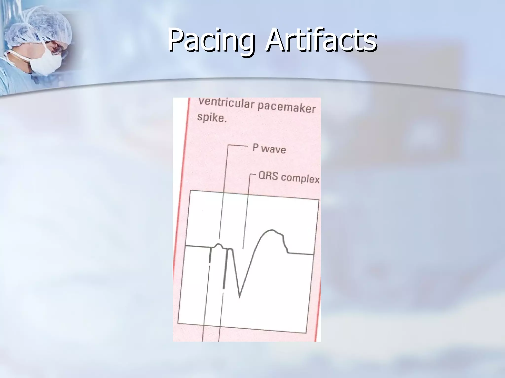 Temporary Pacemaker Slides | PPT