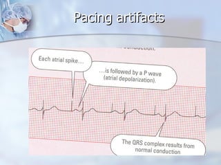 Temporary Pacemaker Slides | PPT