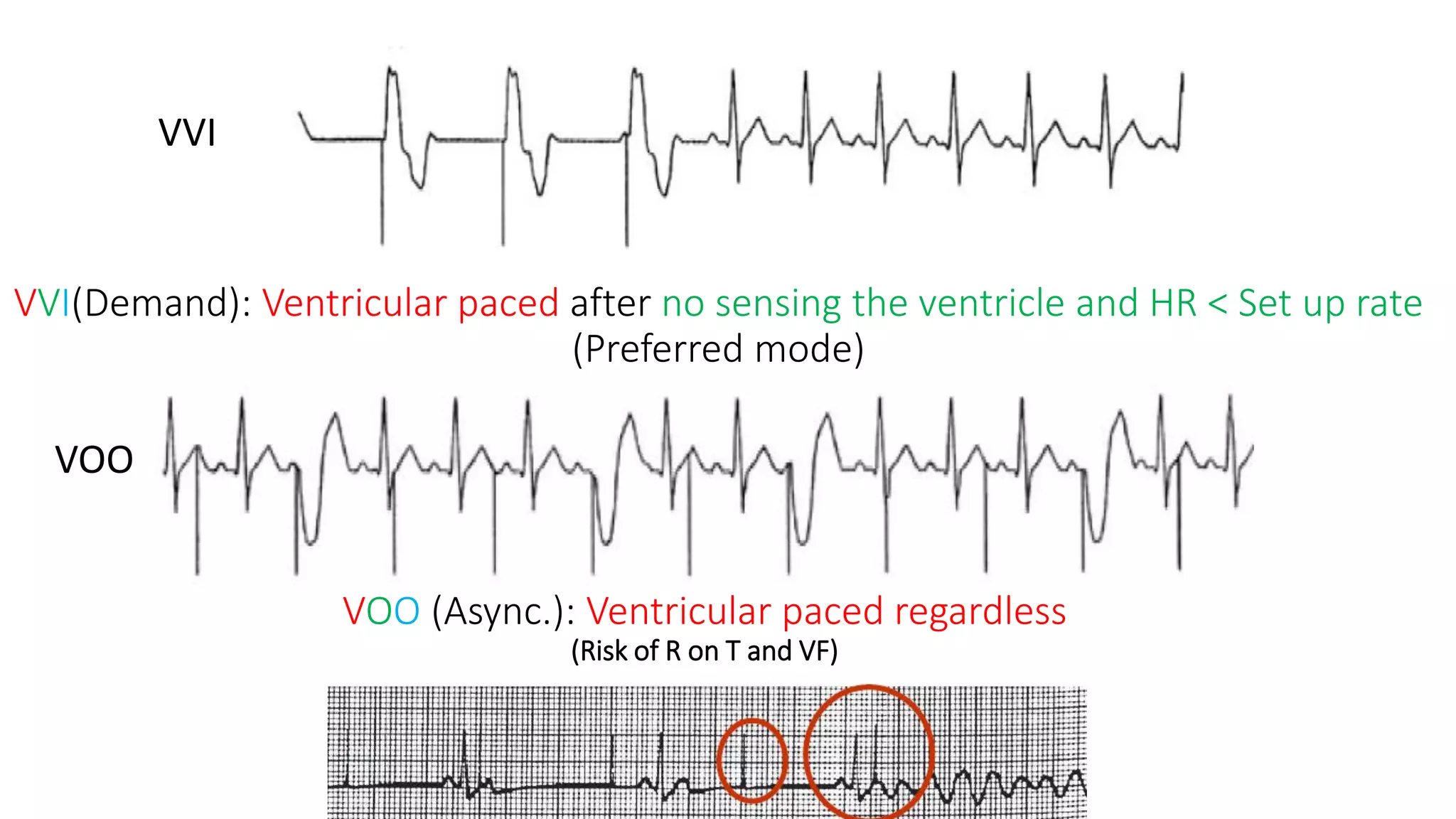 Temporary pacemaker | PDF
