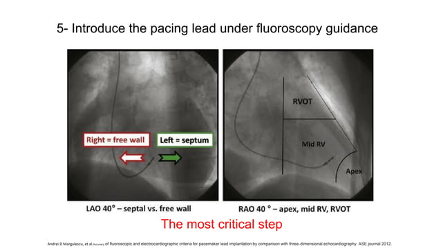 Temporary pacemaker | PDF