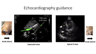 Temporary pacemaker | PDF