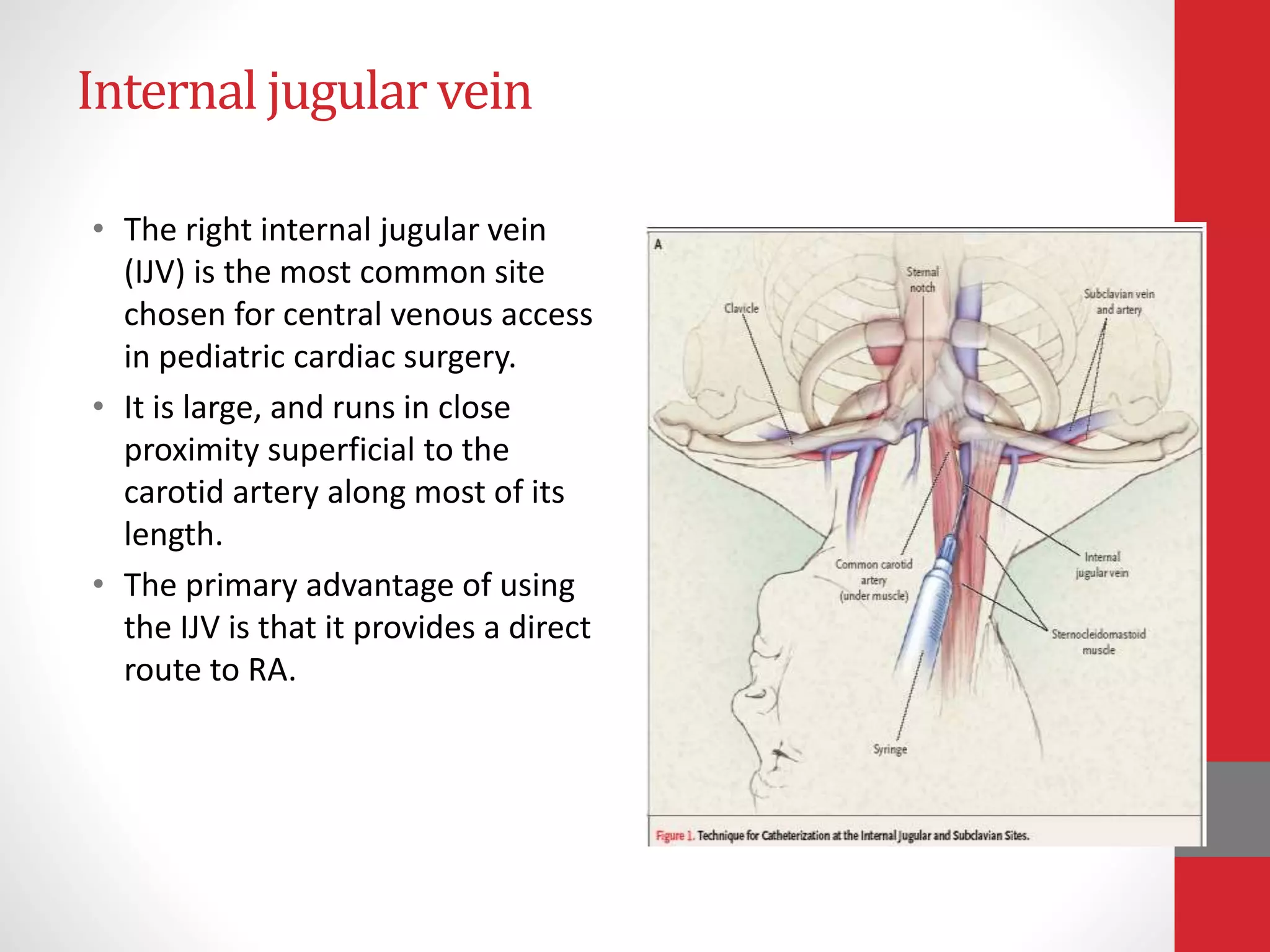 Temporary vascular access for hemodialysis | PPTX