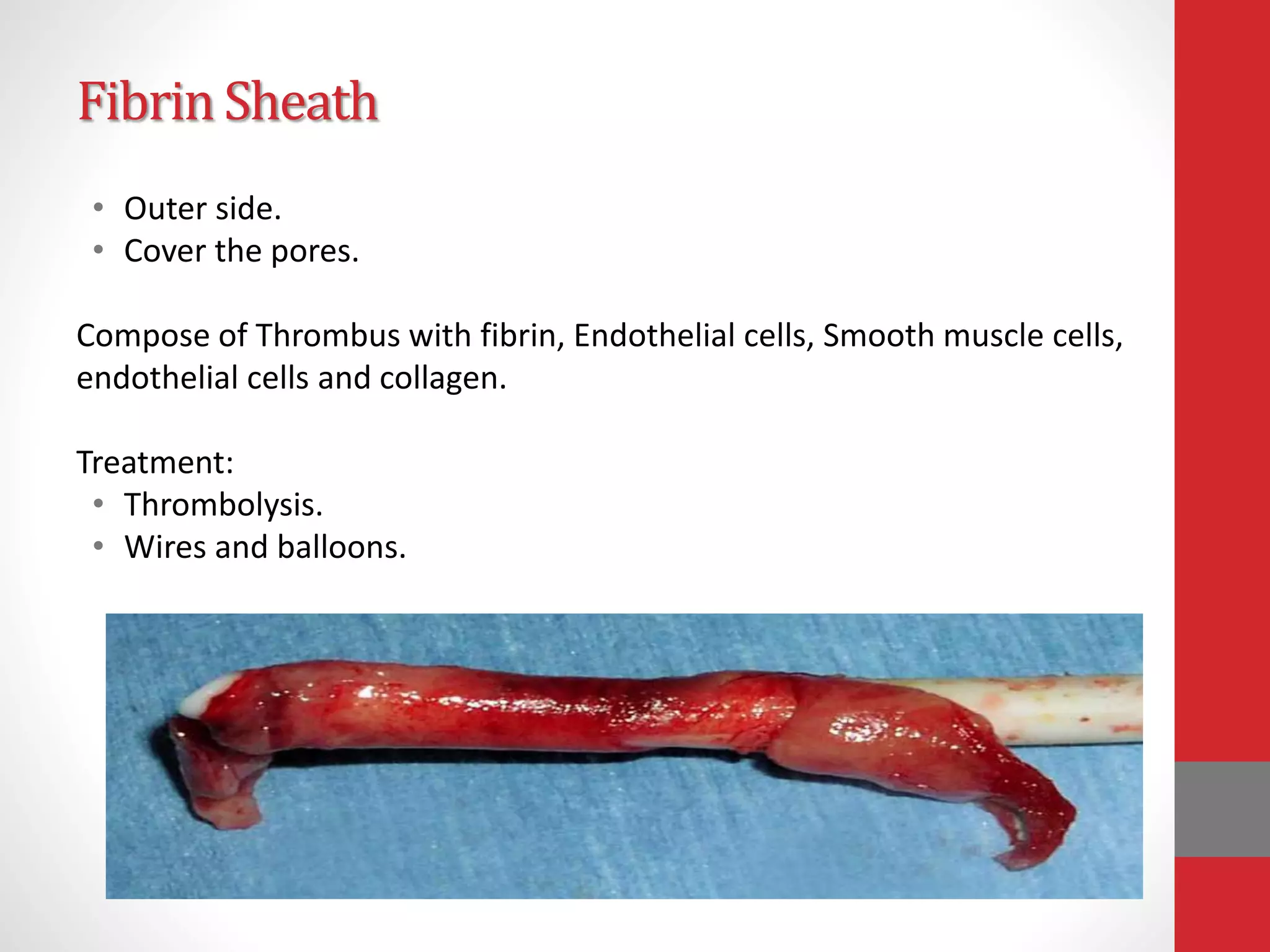Temporary vascular access for hemodialysis | PPTX