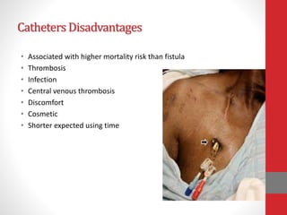 Temporary vascular access for hemodialysis | PPTX