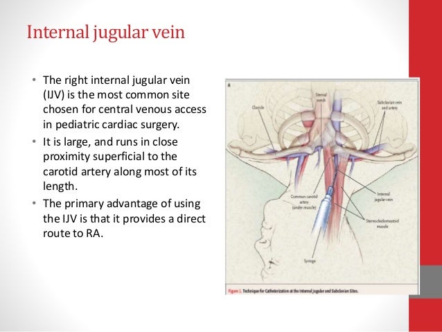 Temporary vascular access for hemodialysis