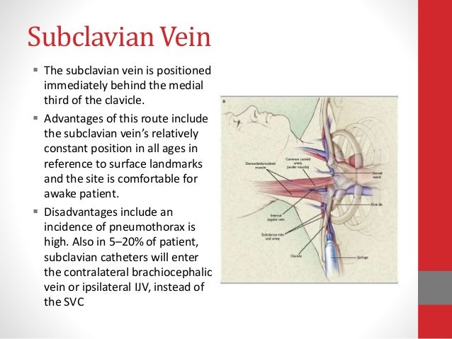 Subclavian Vein Central Line Landmarks