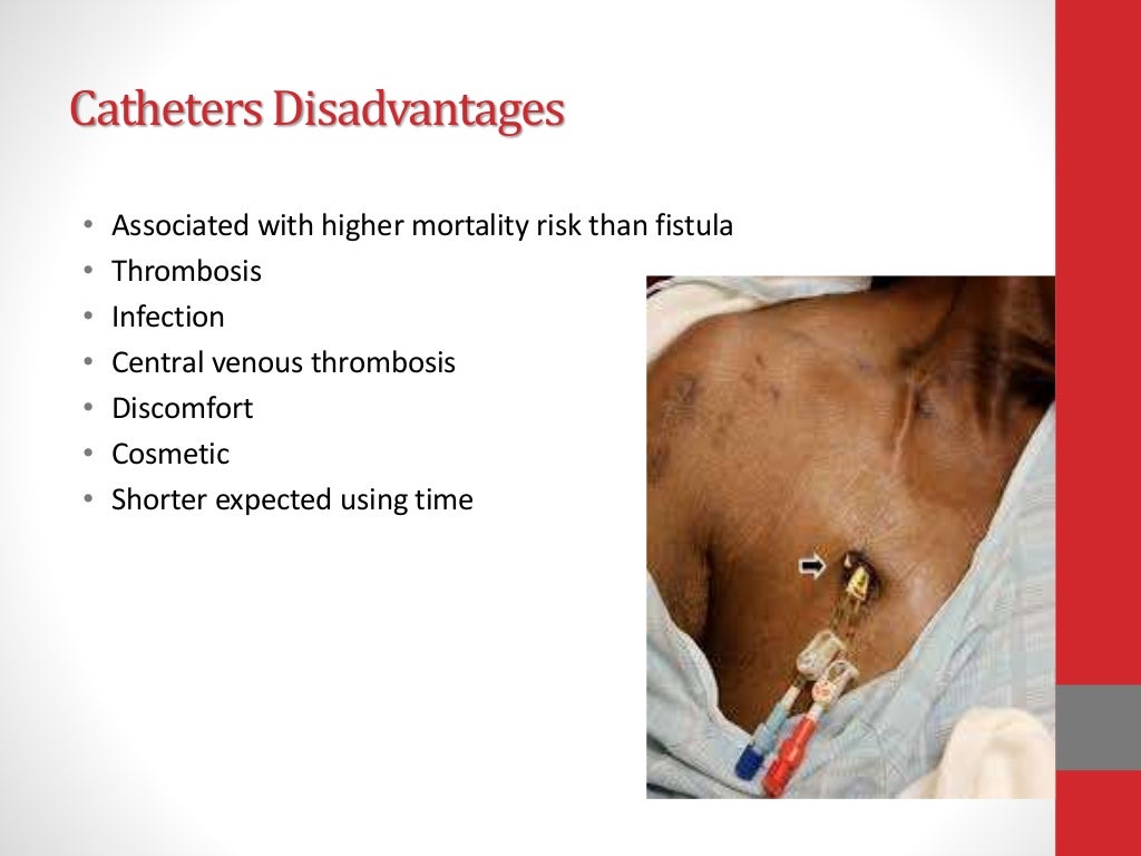 Effective Hemodialysis Access Peachtree Vascular Specialists