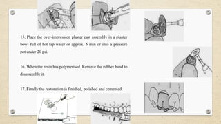 temporization in fixed partial denture prosthodontics | PPT