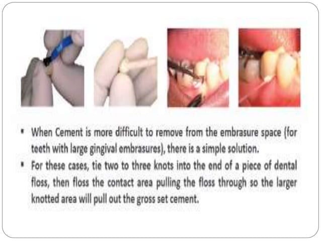 Temporization in fixed prosthodontics | PPTX