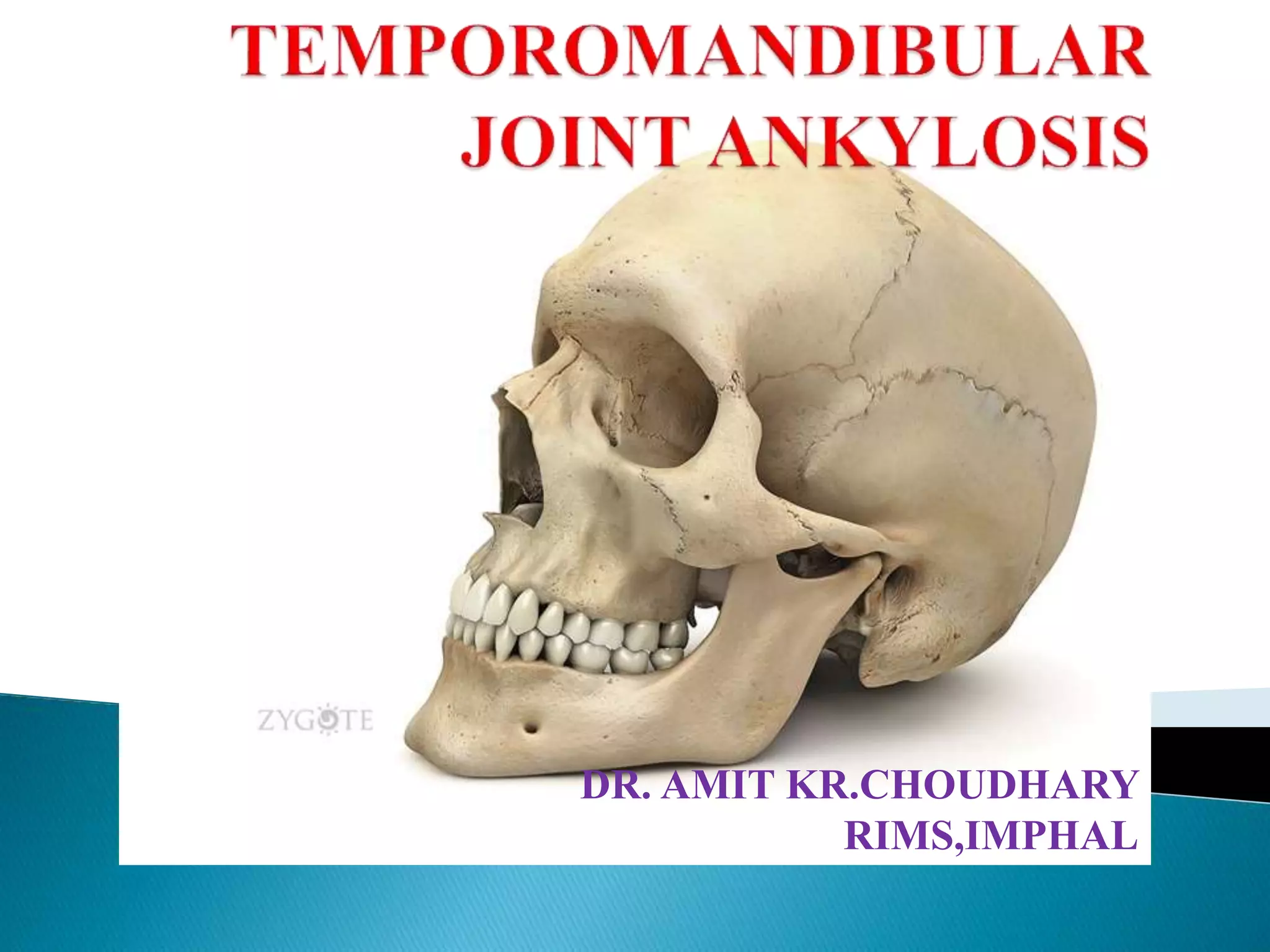 Temporomandibular joint ankylosis | PPTX