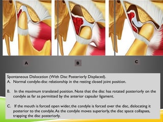 Temporomandibular disorders. The temporomandibular joint (TMJ) is a ...