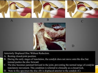 Temporomandibular disorders. The temporomandibular joint (TMJ) is a ...