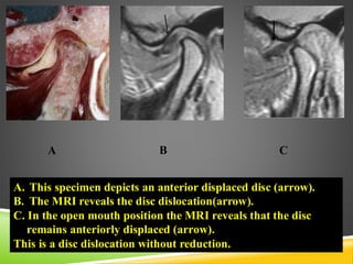 Temporomandibular disorders. The temporomandibular joint (TMJ) is a ...