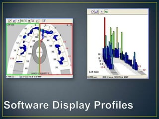 Temporomandibular joint Disorder - T scan | PPTX