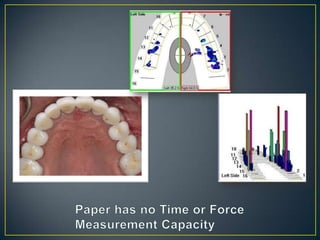 Temporomandibular joint Disorder - T scan | PPTX
