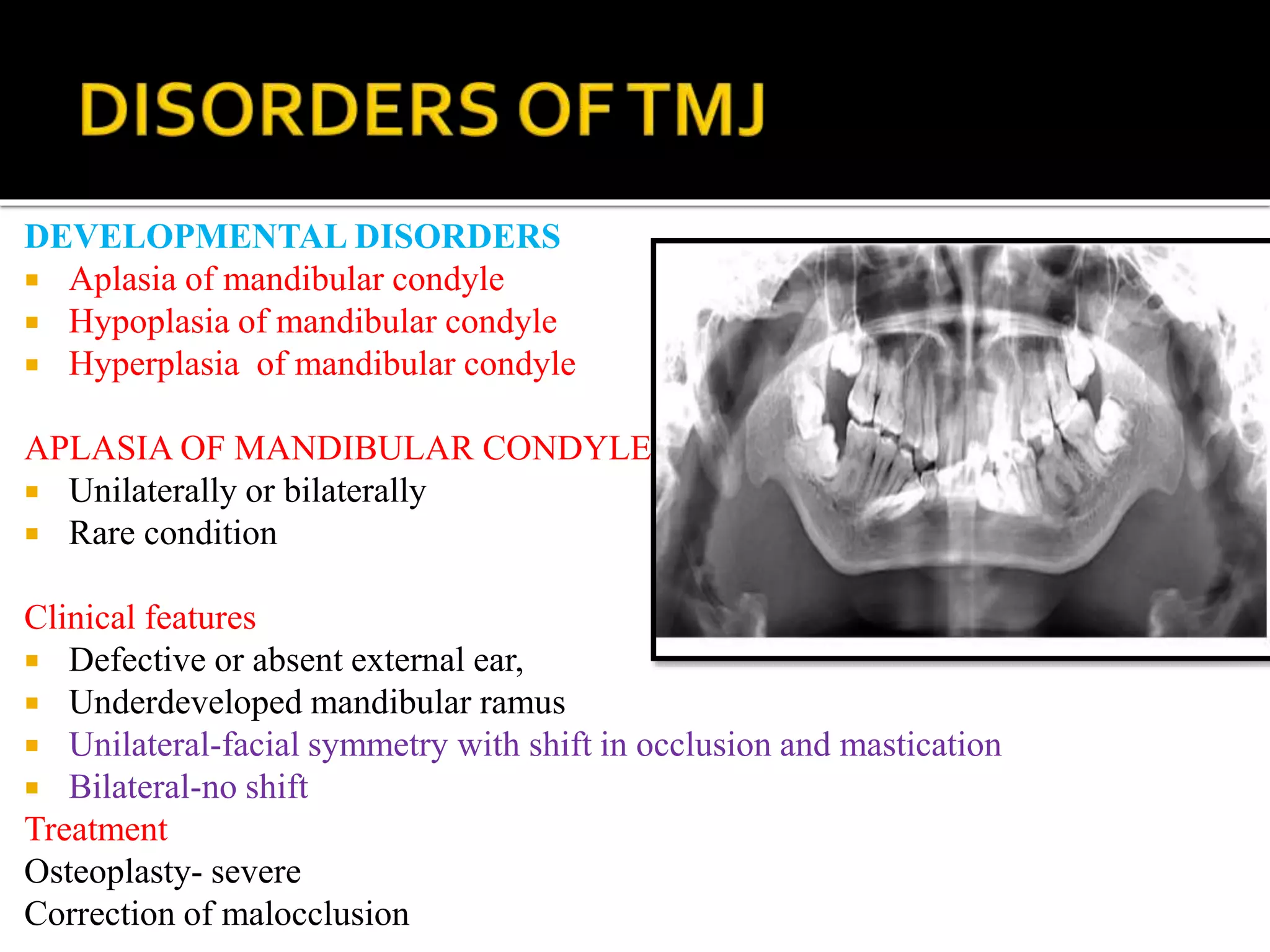 Temporo mandibular joint | PPTX