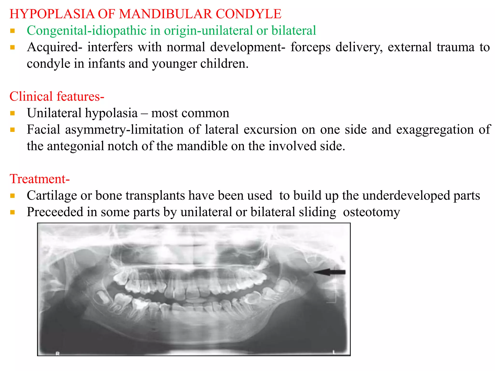 Temporo mandibular joint | PPTX