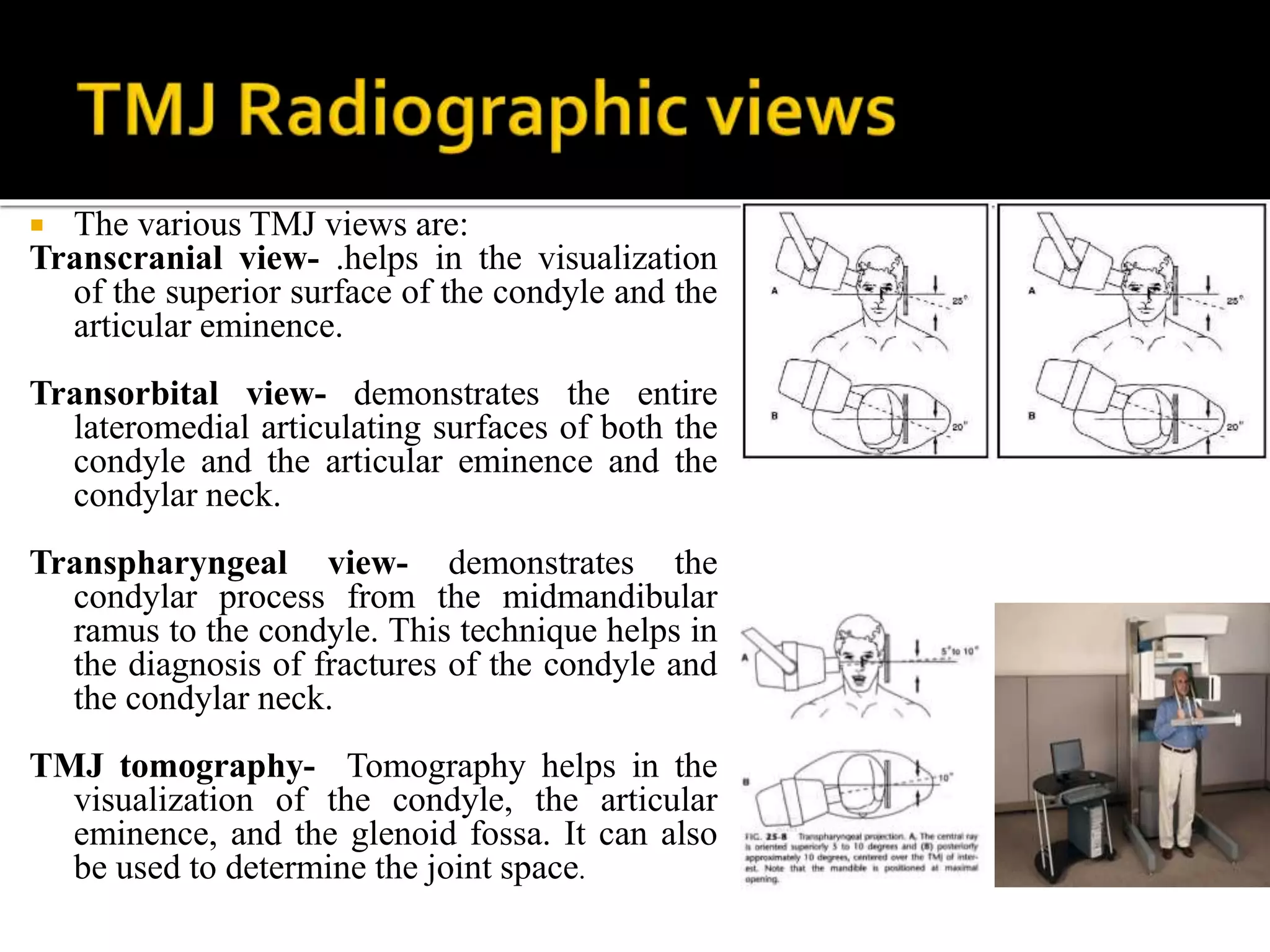 Temporo mandibular joint | PPTX