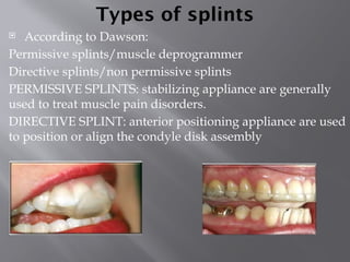 Temporo mandibular joint and its disorders | PPTX