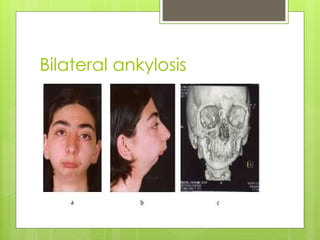 Temporo- mandible joint ankylosis presentation | PPTX