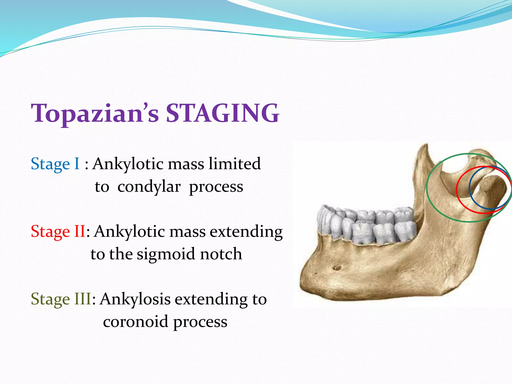 Temporomandibular joint ankylosis | PPTX