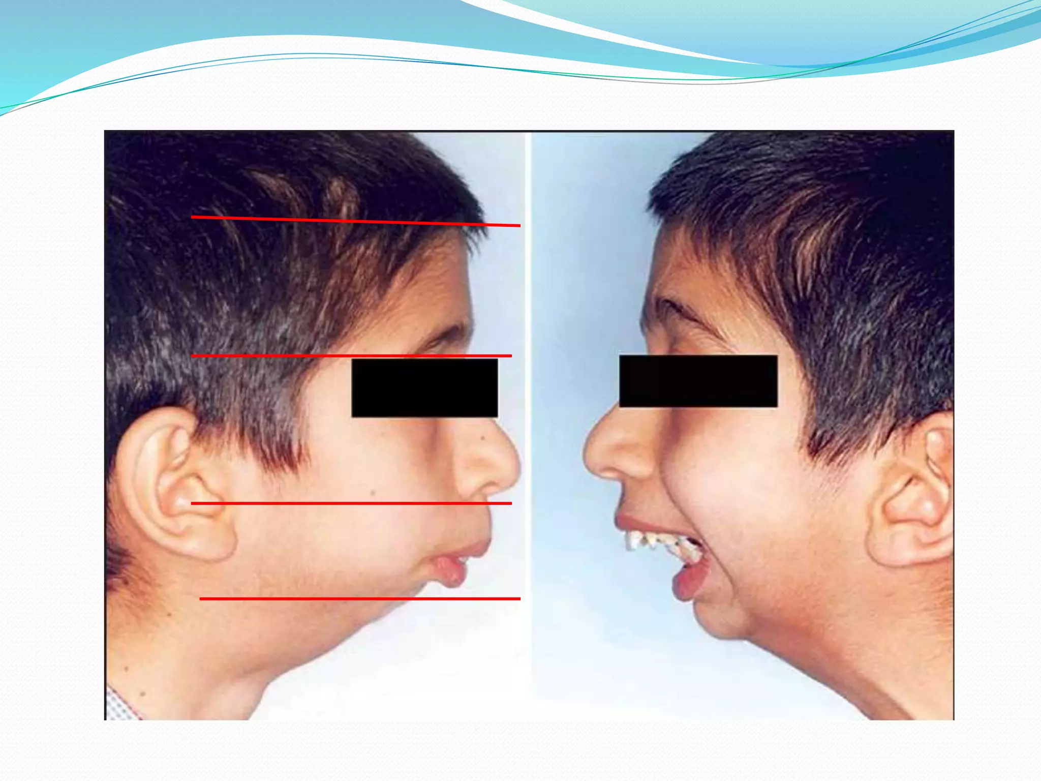 Temporomandibular joint ankylosis | PPTX