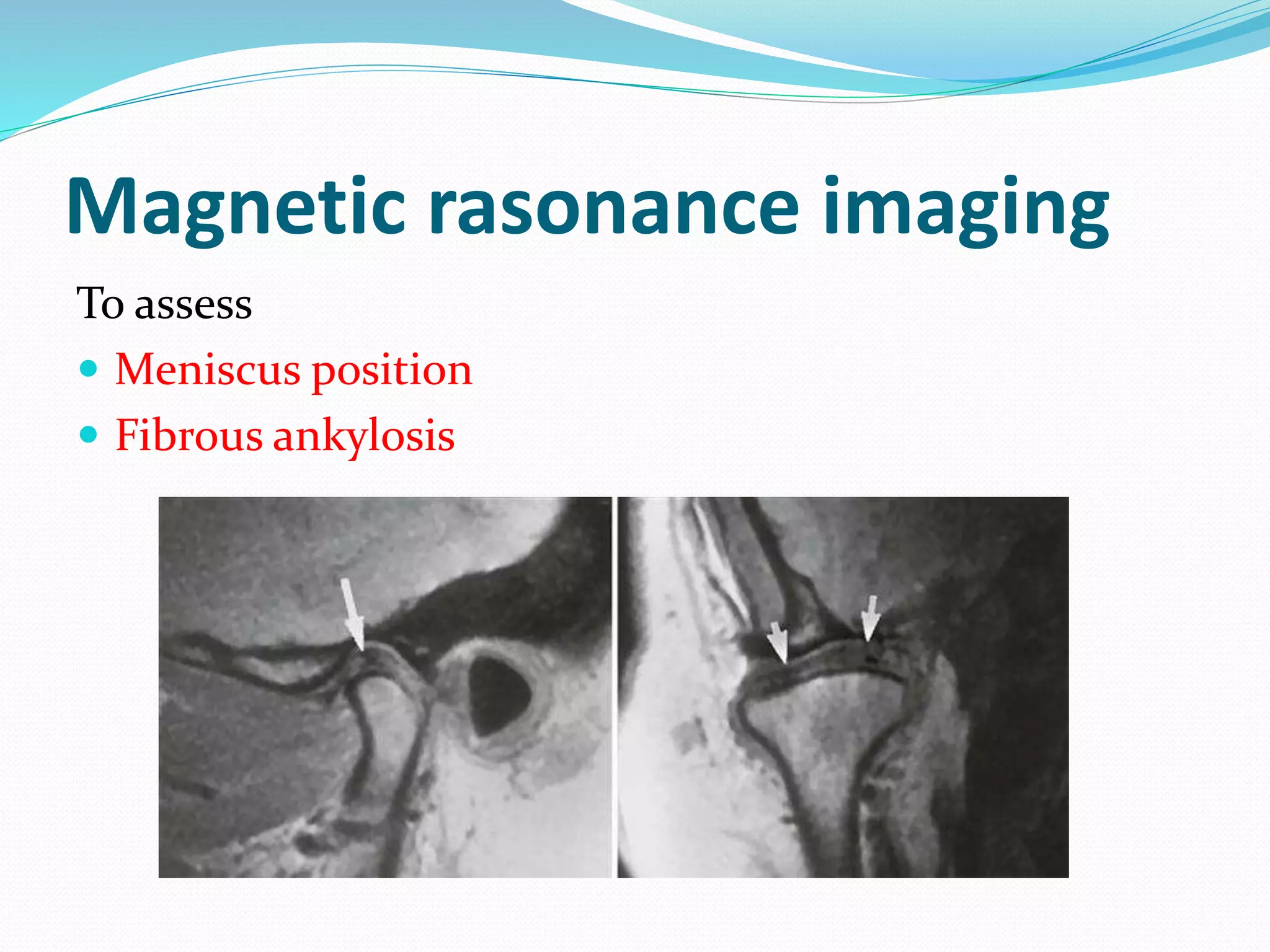 Temporomandibular joint ankylosis | PPTX
