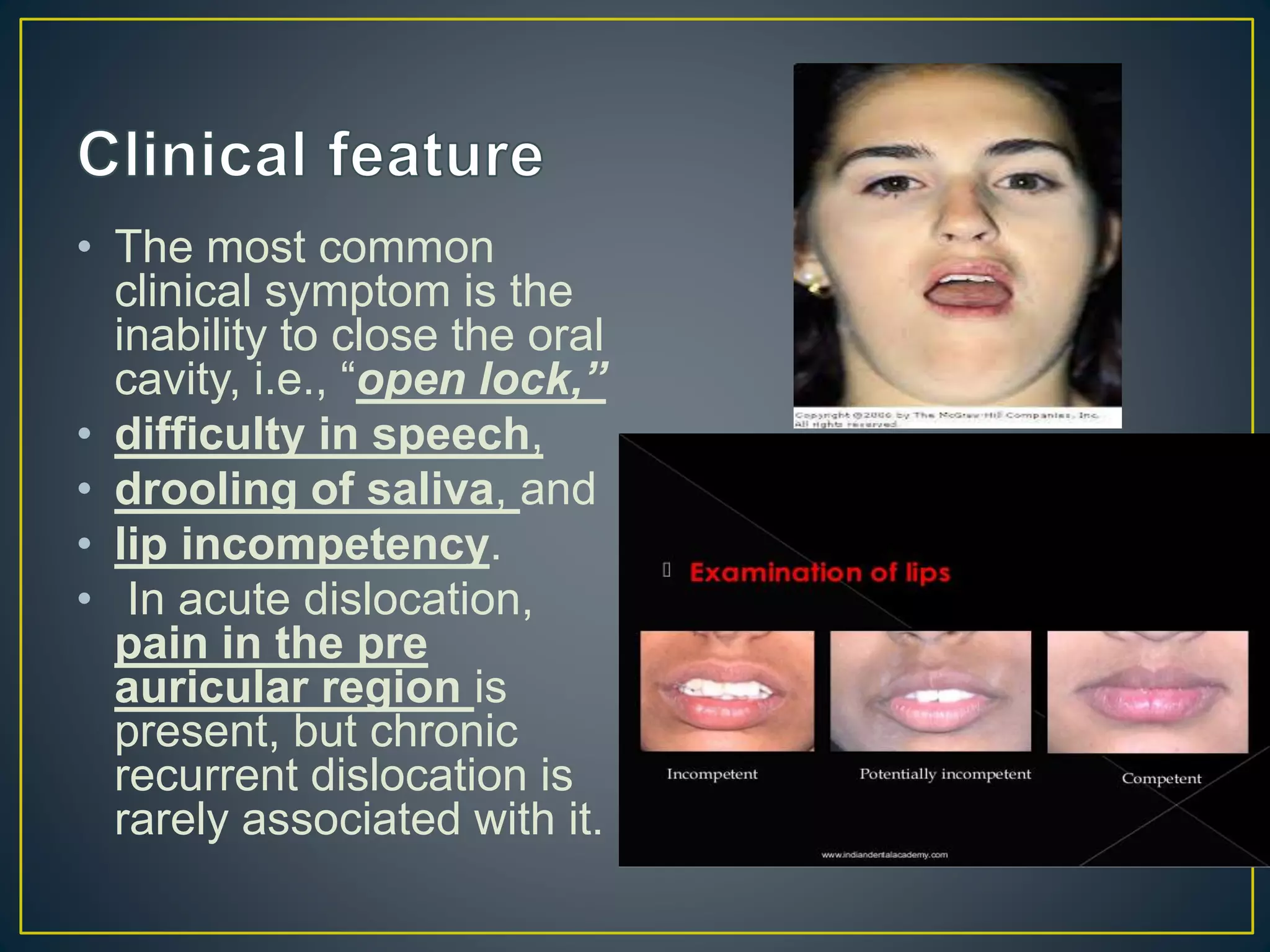 Temporomandibular joint dislocation | PPTX