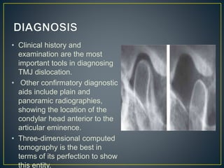 Temporomandibular joint dislocation | PPTX