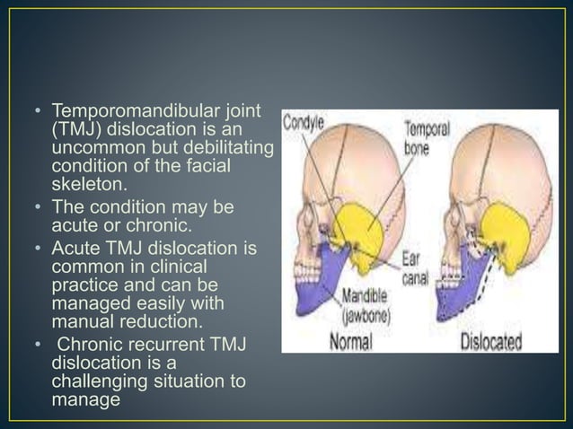Temporomandibular joint dislocation | PPT