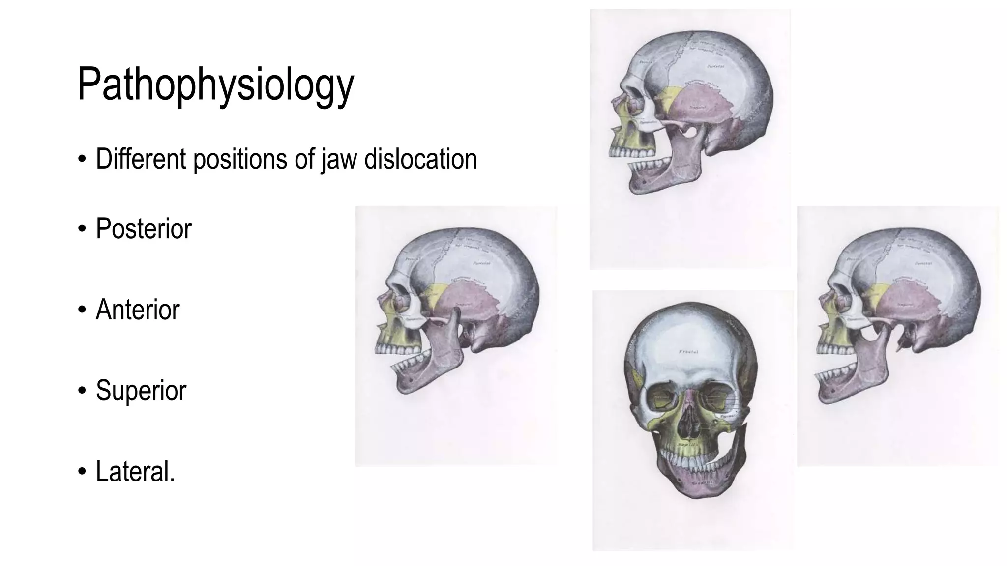 Temporomandibular joint dislocation | PPTX