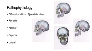 Temporomandibular joint dislocation | PPTX