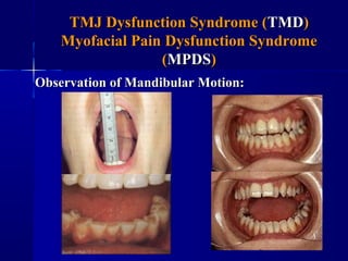 Temporomandibular joint disorder | PPT