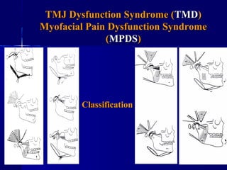 Temporomandibular joint disorder | PPT