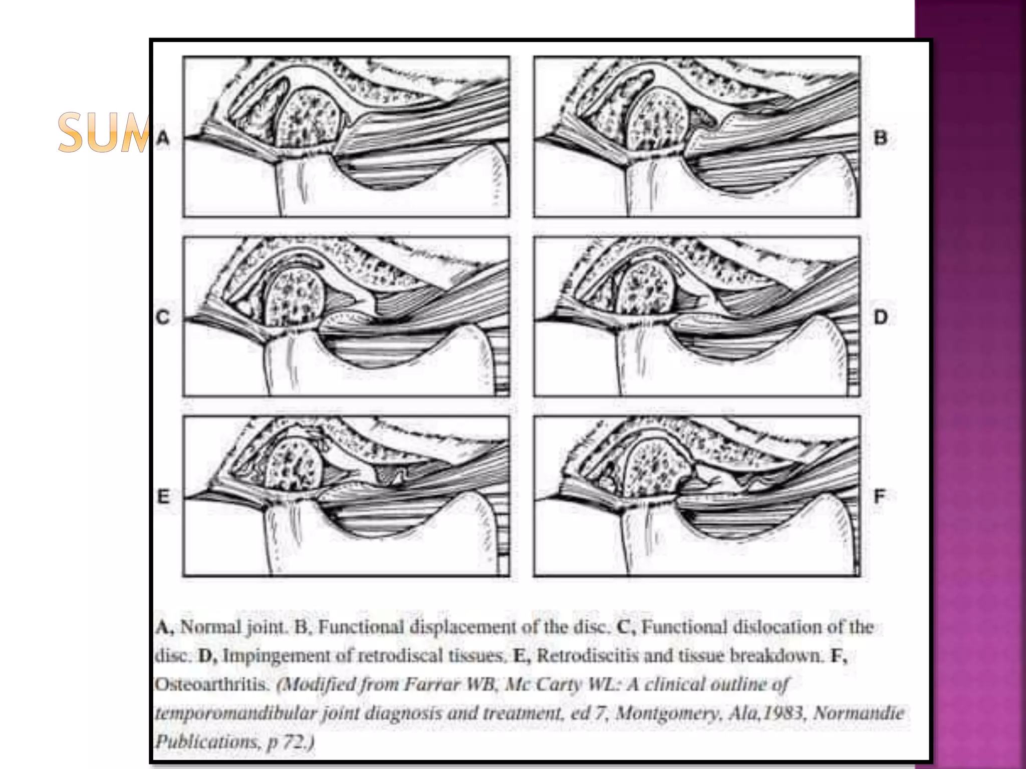 Temporomandibular Joint Disorders Ppt