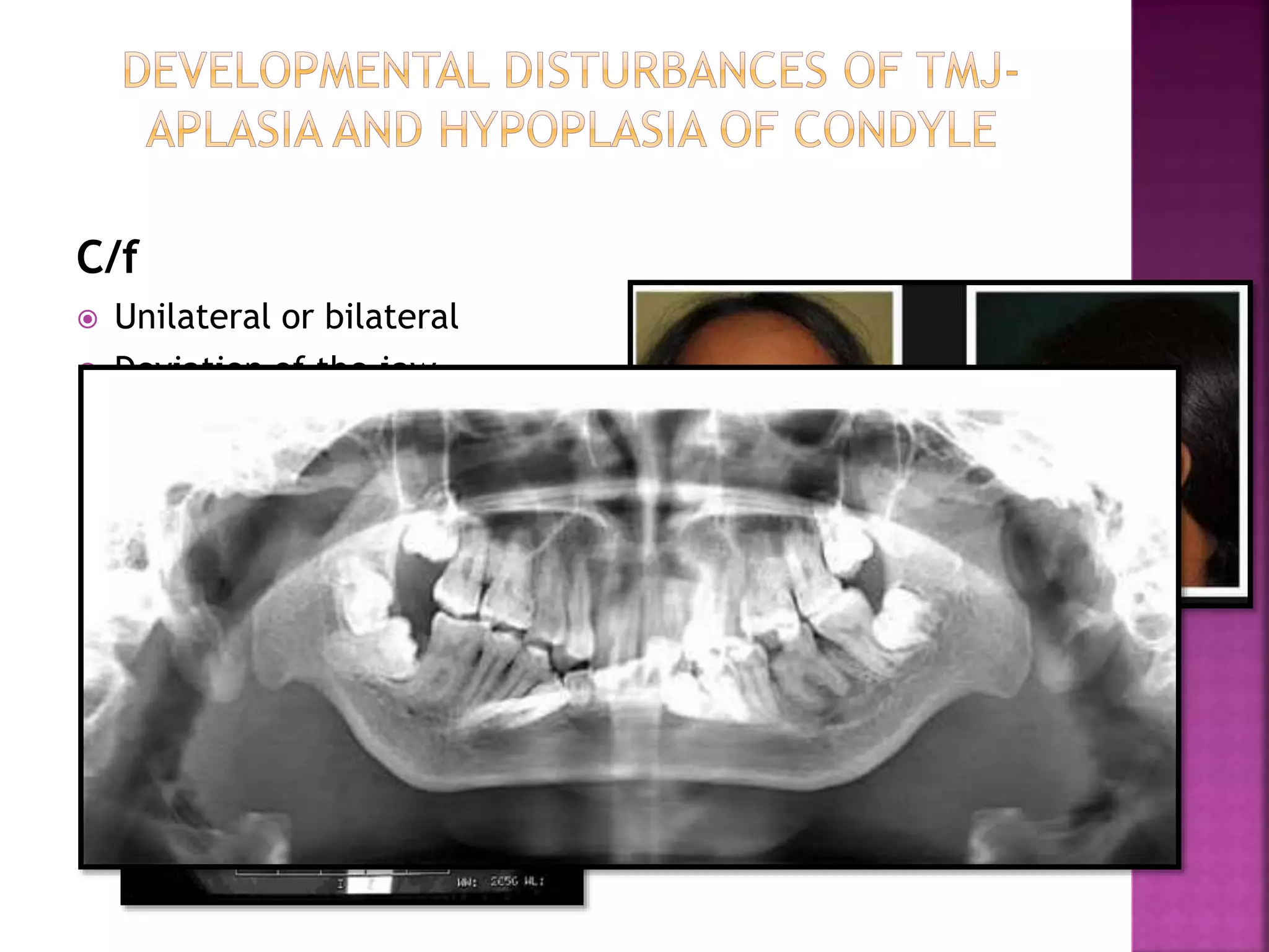 Temporomandibular joint disorders | PPTX