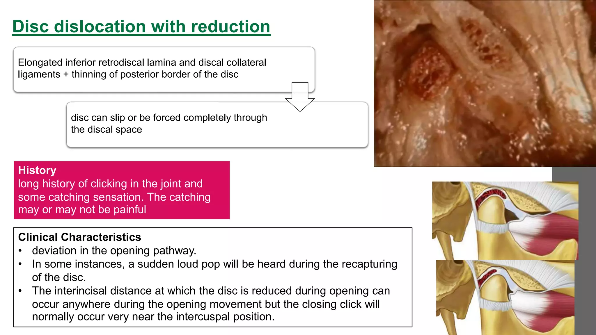 Temporomandibular joint disorders | PPTX