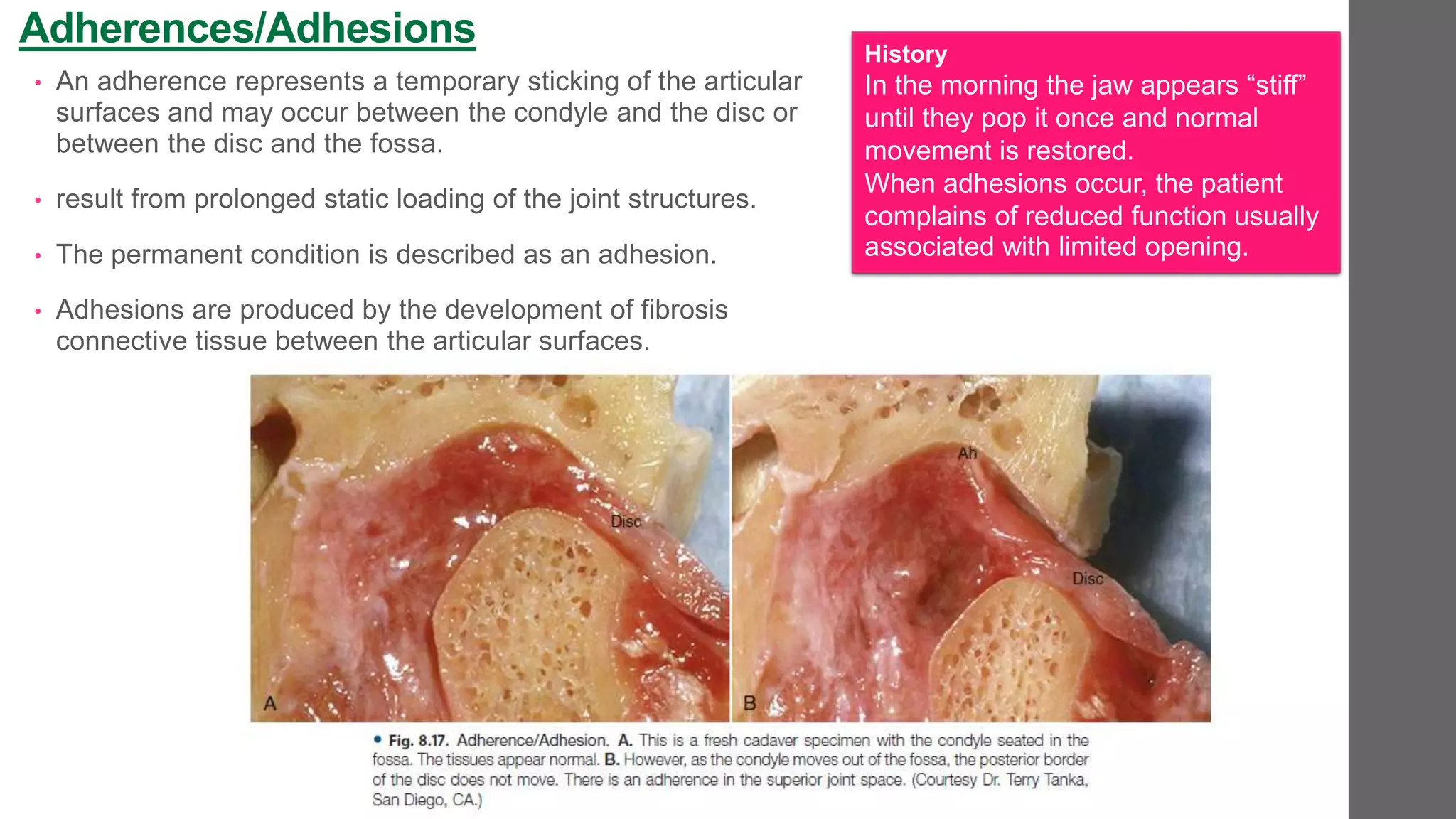 Temporomandibular joint disorders | PPTX