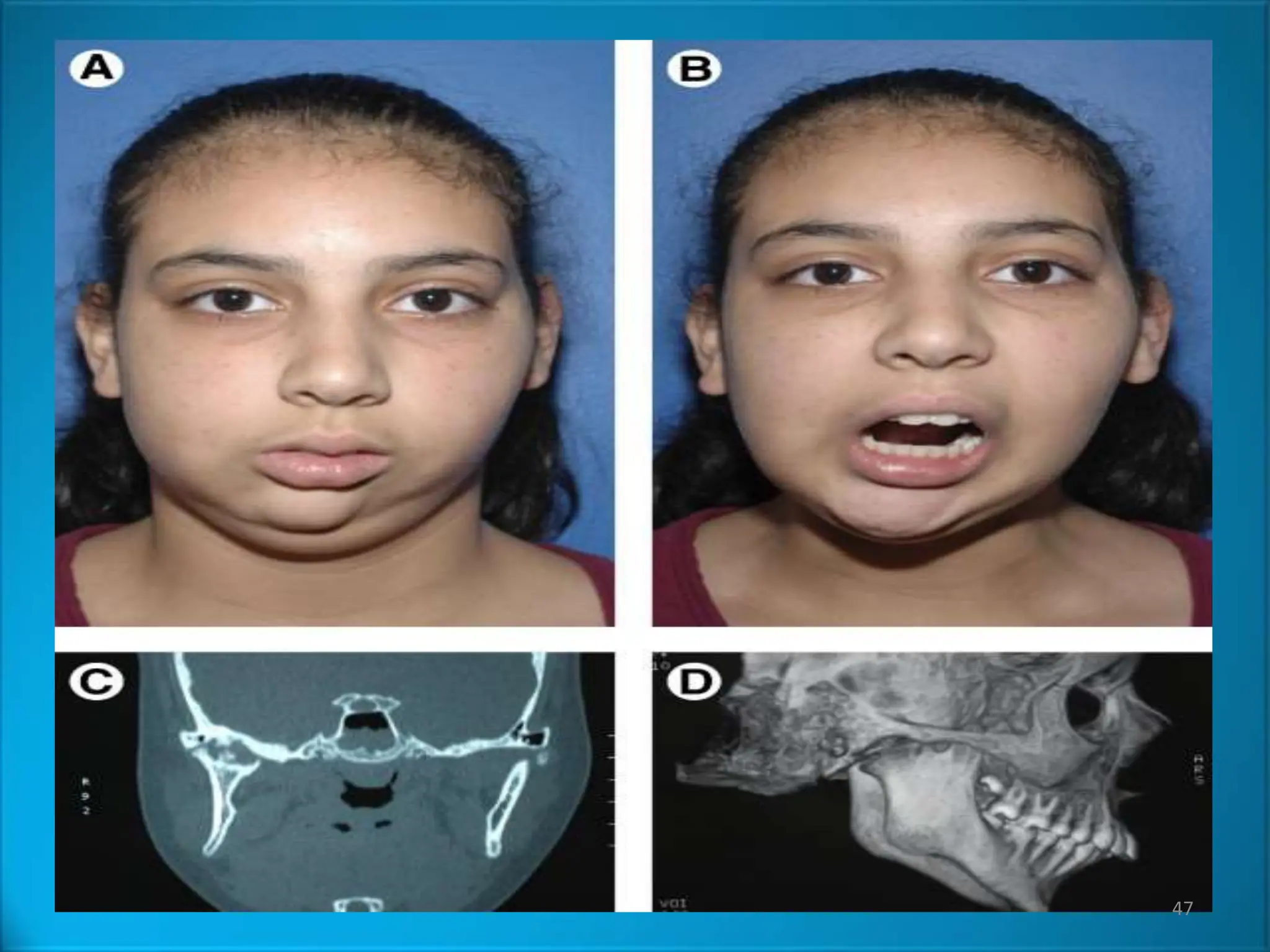 TEMPOROMANDIBULAR JOINT DISORDERS AND ITS PROSTHETIC MANAGEMENT (2 ...