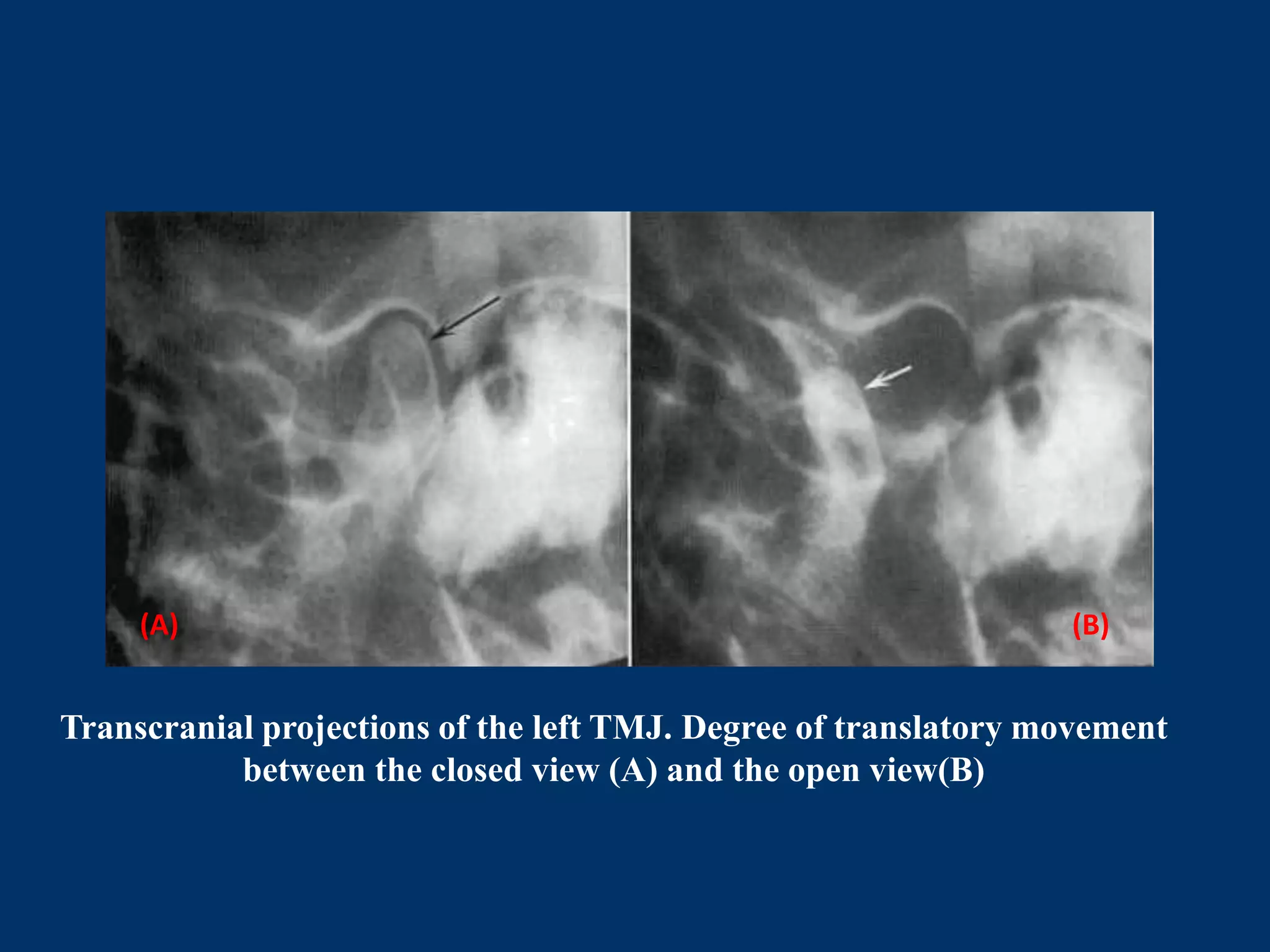 Temporomandibular joint imaging | PPTX